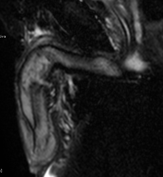 Cavernosal Hematoma-MRI - Sumer's Radiology Blog