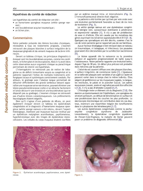 GedaRnet.com Le Maillon Faible .: Lésion blanche de la muqueuse buccale