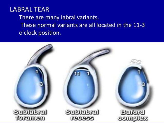 MRI Musculo-Skeletal Section: MRI anatomy of the shoulder (ABER view).