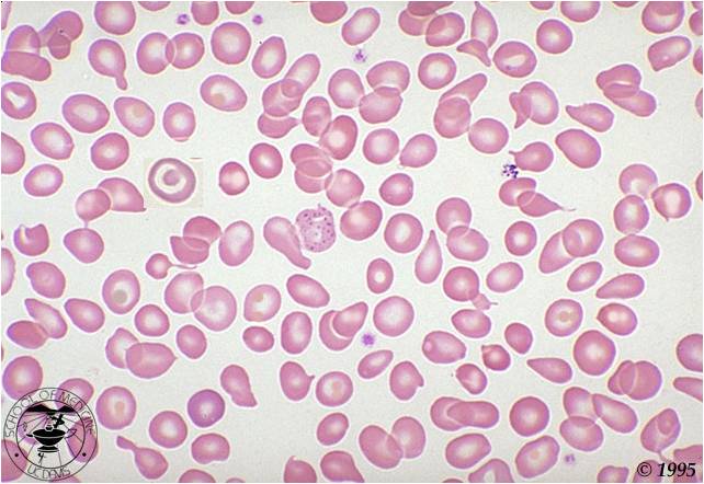 Células Sanguíneas: Poiquilocitosis