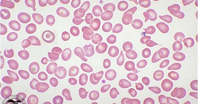 Células Sanguíneas: Poiquilocitosis