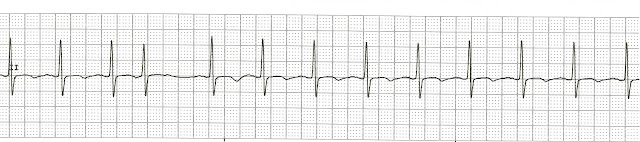 EKG Rhythm Strip Quiz 72