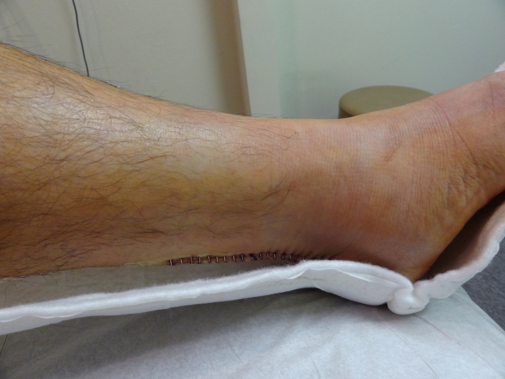 Run Lily Run: Ruptured Achilles Tendon - Day 16 - Post Op Day 4