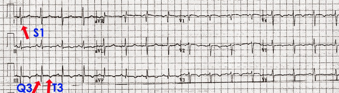 Everyday E(B)M: EKG Challenge #5 Case Conclusion: Impostor!