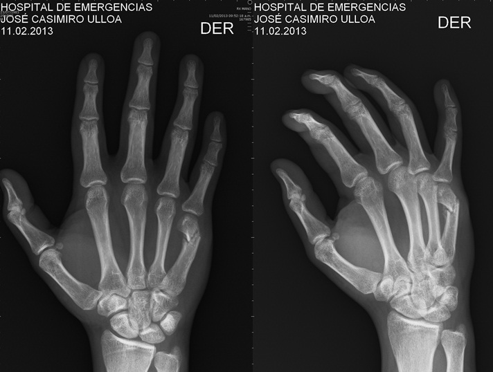 CASIMIRO RADIACTIVO: PASEANDO POR RAYOS X