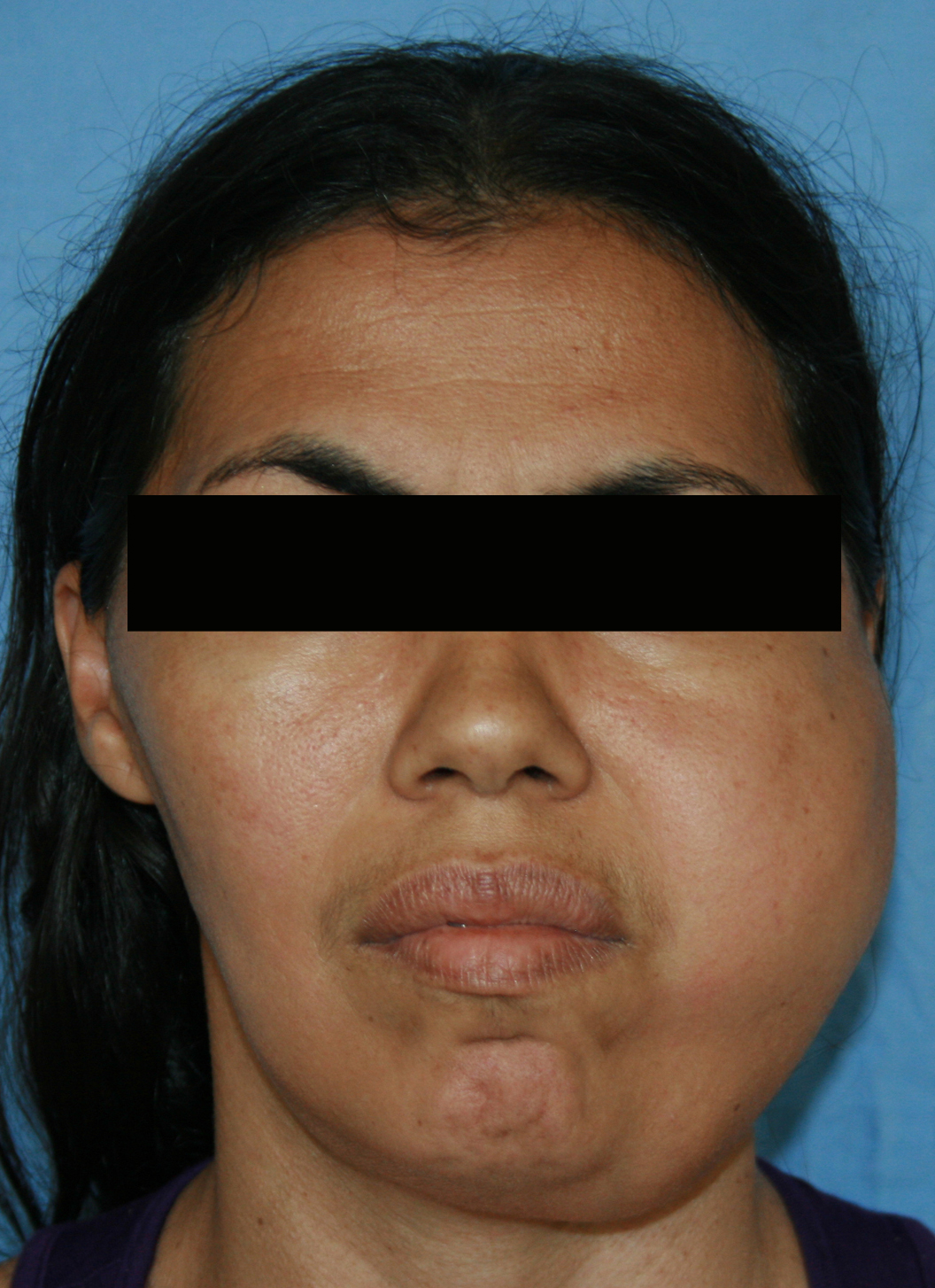 Cirurgia BucoMaxiloFacial & Implantodontia: Área de atuação do ...