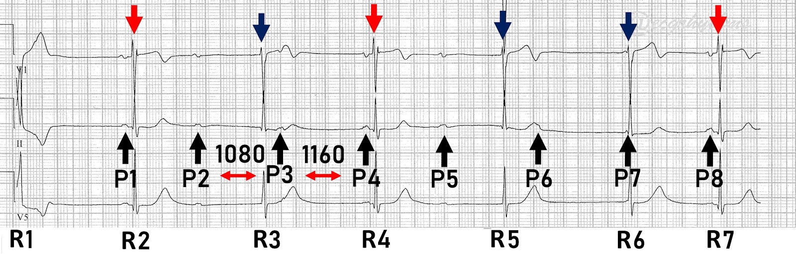 ECG Rhythms: Advanced Heart Block