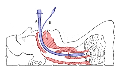 Respiratory Therapy Cave: What is intubation?