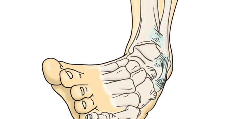 Primeros Auxilios Básicos en el lugar de Trabajo: Esguince