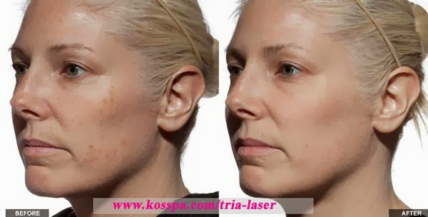 Tria Age Defying Laser Scam Or Not Cool And Awesome Stuff To Buy