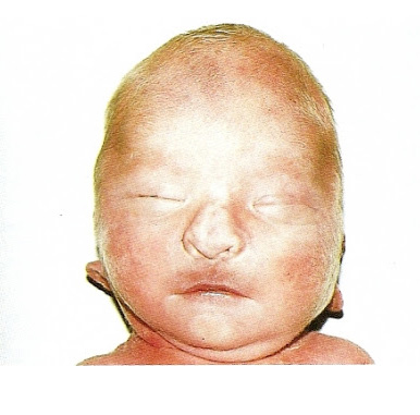 SINDROME DE POTTER - BIENVENIDOS