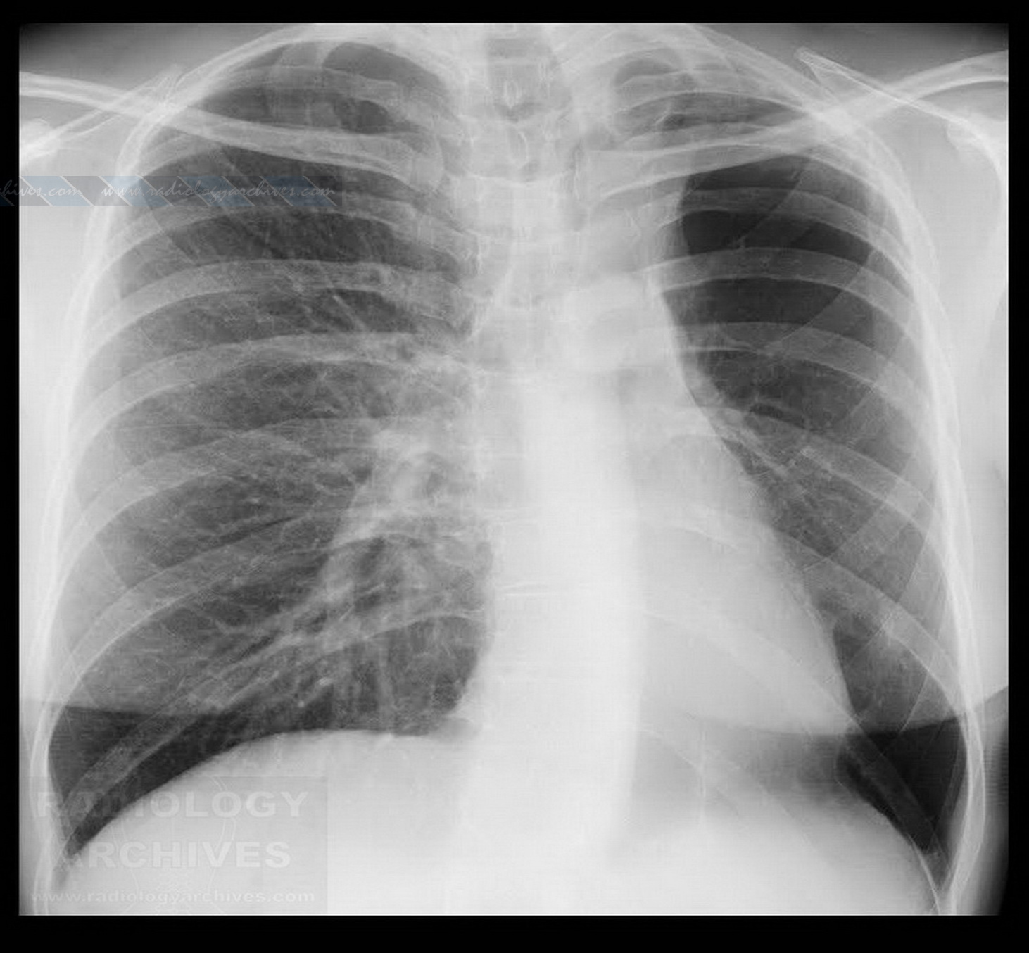 Radiology Archives: Eτερόπλευρo - Λοβιακό Εμφύσημα (Σύνδρομο Swyer ...