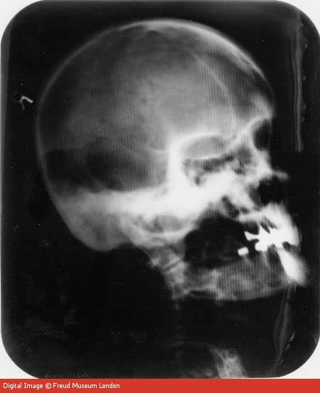 EL CÁNCER DE SIGMUND FREUD. PERCY ZAPATA MENDO.