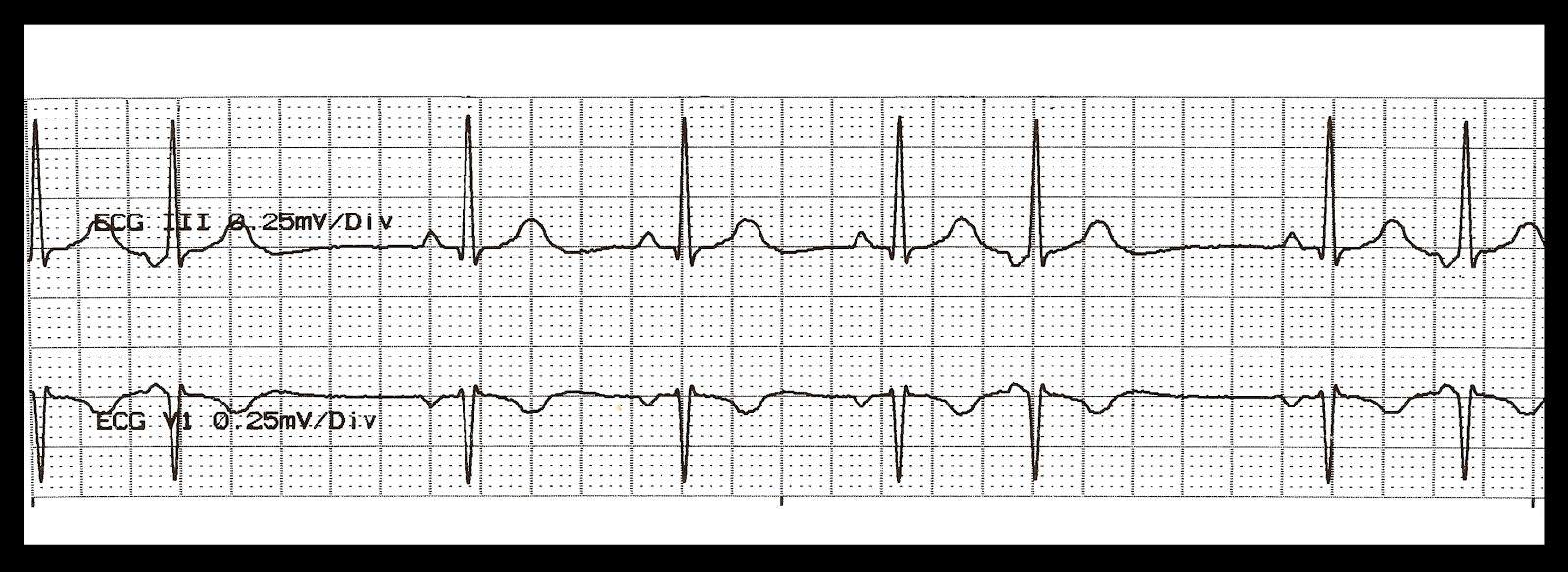 Float Nurse: Practice EKG Strips 312