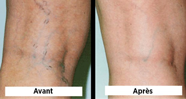 Que faire apres une operation des varices - Roger Parker