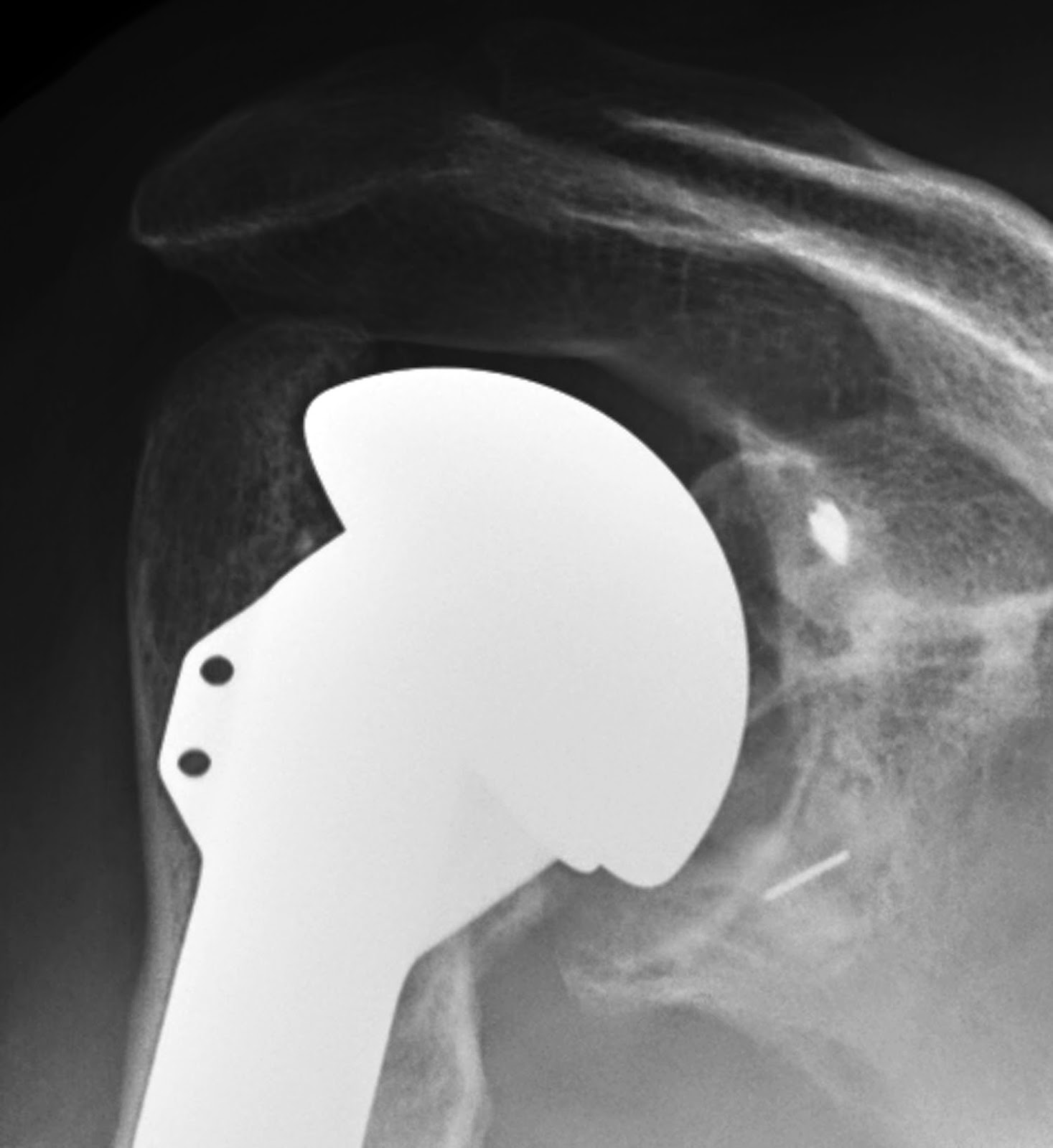 UW Shoulder and Elbow Academy: The rotator cuff deficient shoulder ...