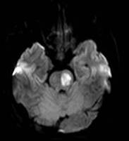 Basilar Artery Thrombosis-MRI - Radiology Imaging