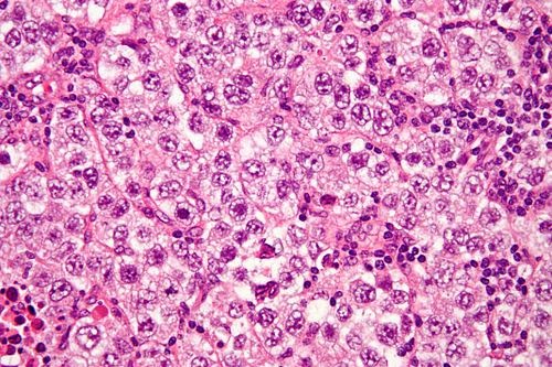 Germ cell tumor