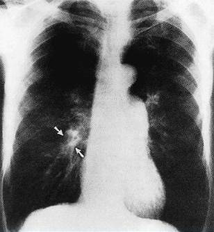 Kor Pulmonal ~ Informasi Kedokteran Dan Kesehatan