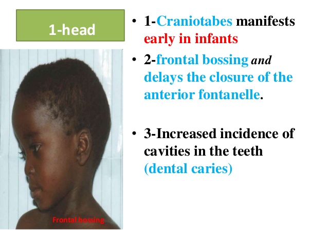 craniotabes - USA News Collections
