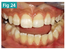 Molar Incisor Hypomineralization (MIH): Conservative Treatment Approach