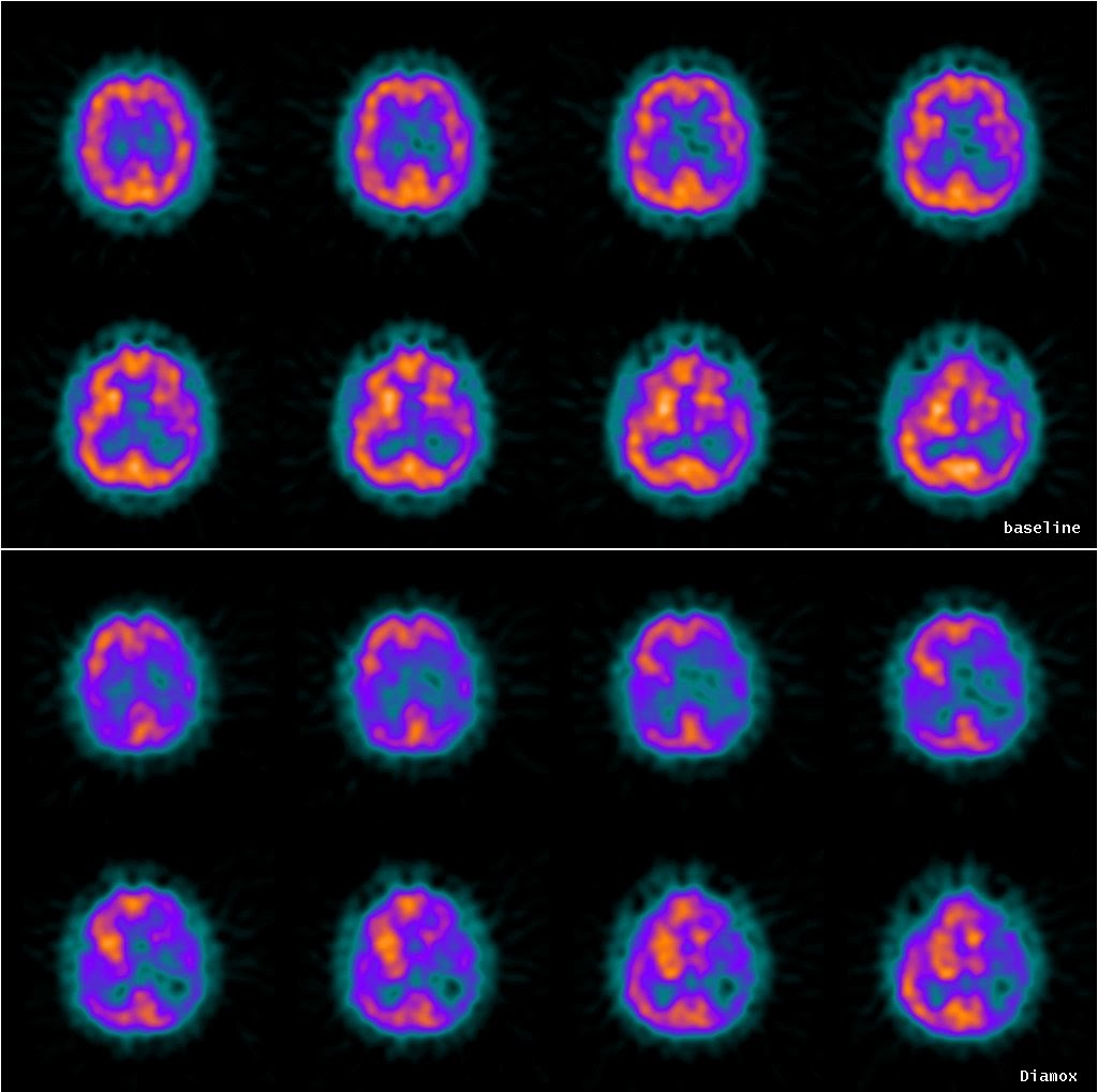 Tecnologia em Radiologia: Os Equipamentos de SPECT/CT