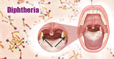 Diphtheria Symptoms , Natural Treatment