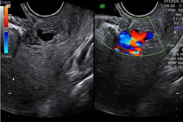 AVM IN CESAREAN SCAR-USG - Sumer's Radiology Blog