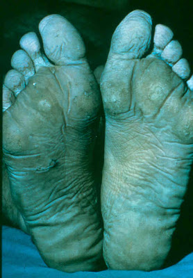 Deformutilation: Trench Foot