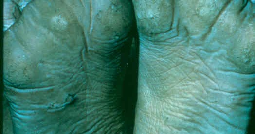 Deformutilation: Trench Foot