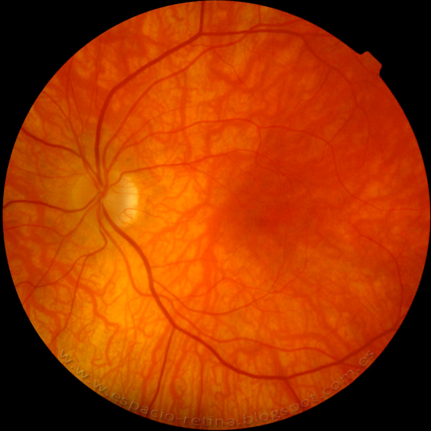 ESPACIO RETINA: Hipopigmentación retiniana.