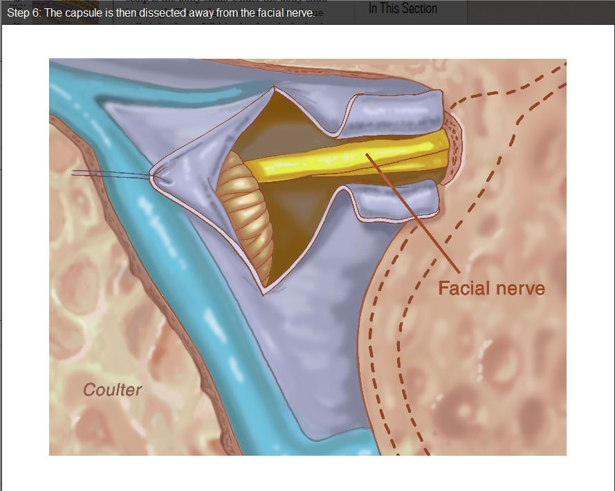 Arnold the Acoustic Neuroma: The Trans-what?-ian approach?
