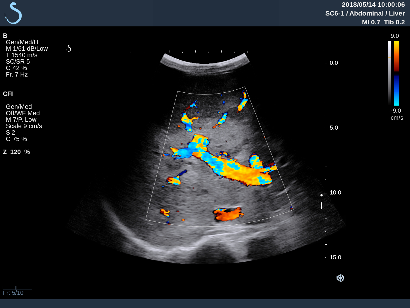 VIETNAMESE MEDIC ULTRASOUND: CASE 494: PRIMARY LIVER LYMPHOMA (PLL),Dr ...