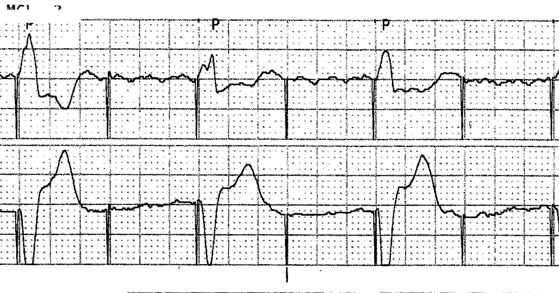 ECG Rhythms: Intermittent Ventricular Noncapture