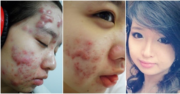 Inilah 5 Treatment Yang Wajib Kamu Lakukan Untuk Menghilngkan Bopeng ...