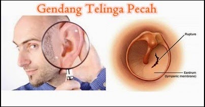 Obat Gendang Telinga Pecah - Cara Mengobati Penyakit Alami