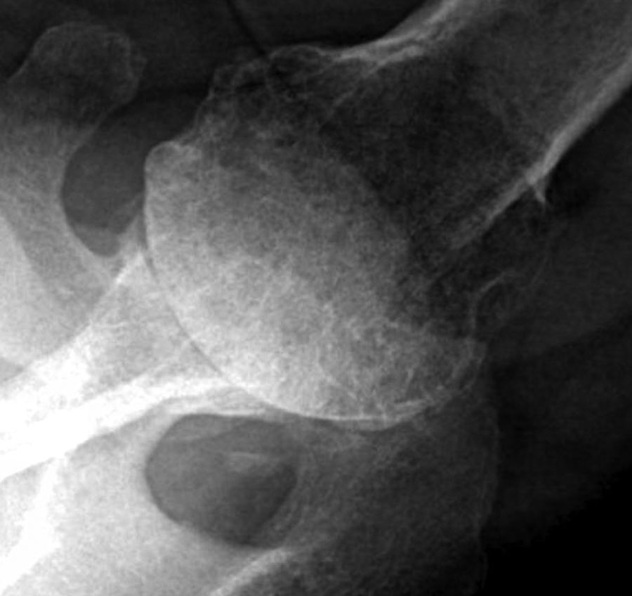 UW Shoulder and Elbow Academy: Rotator cuff tear arthropathy of the ...