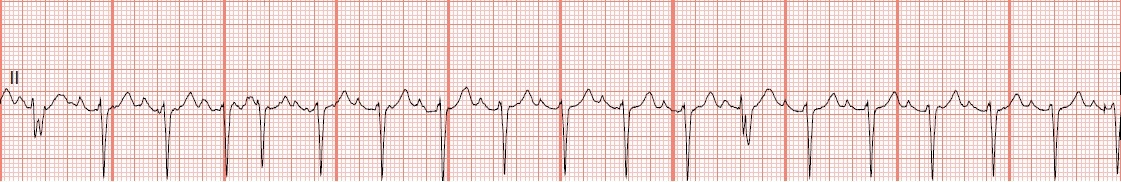 EKG Rhythm Strip Quiz 38