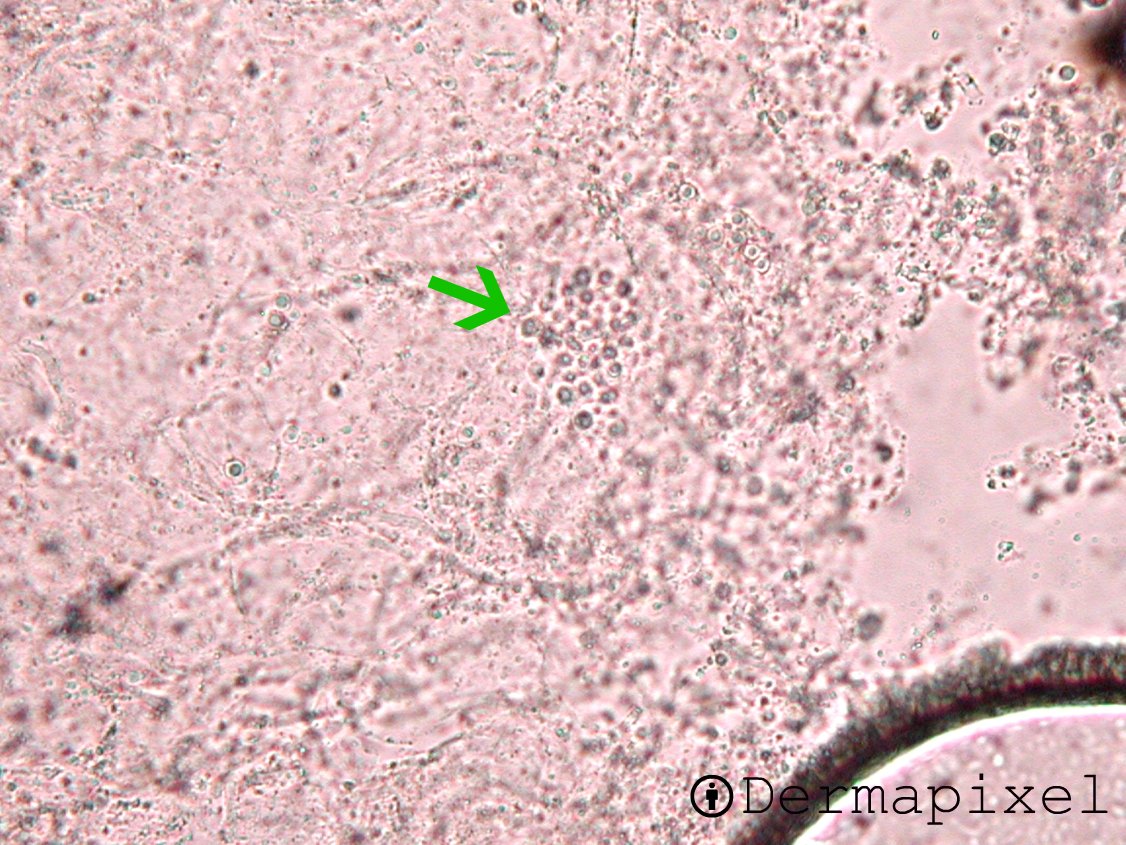 Dermapixel: En busca de albóndigas y espaguetis