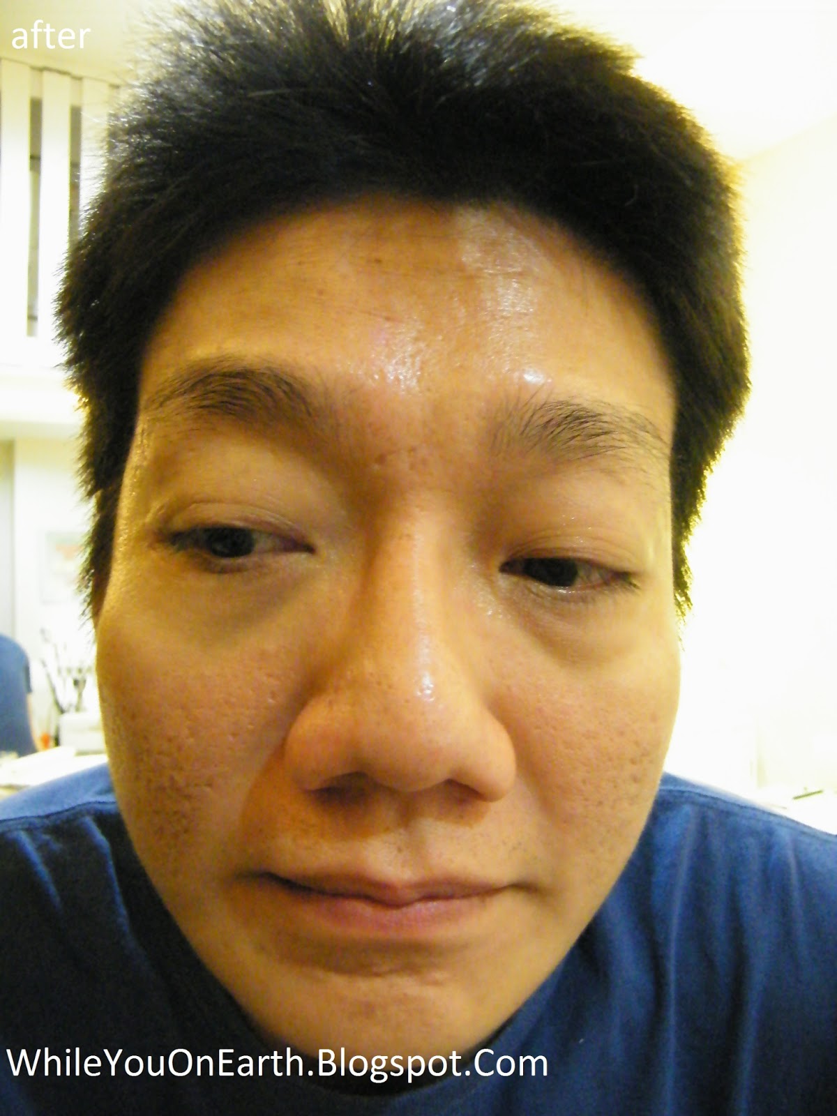 While you on earth..: ZAP Eye Treatment