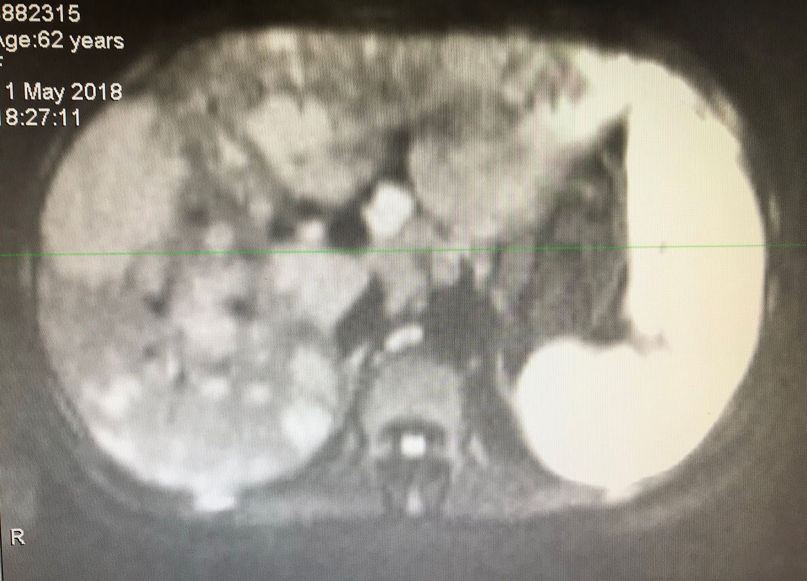 VIETNAMESE MEDIC ULTRASOUND: CASE 494: PRIMARY LIVER LYMPHOMA (PLL),Dr ...
