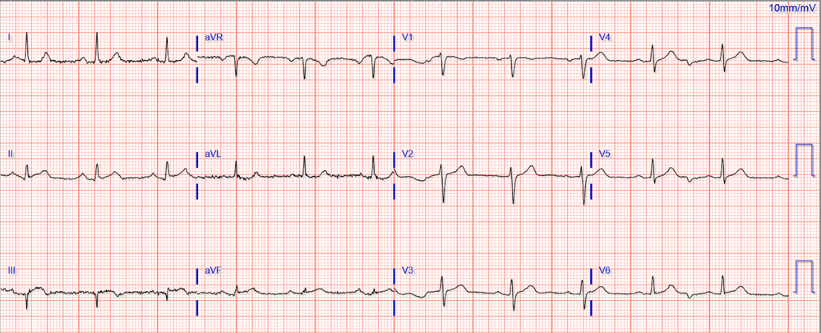Dr Smith s ECG Blog The Computer Calls This A normal ECG We ll dr-smith-s-ecg-blog-the-computer-calls-this-a-normal-ecg-we-ll