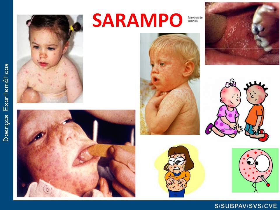 SARAMPO | CENTRO MUNICIPAL DE SAÚDE JOÃO CÂNDIDO