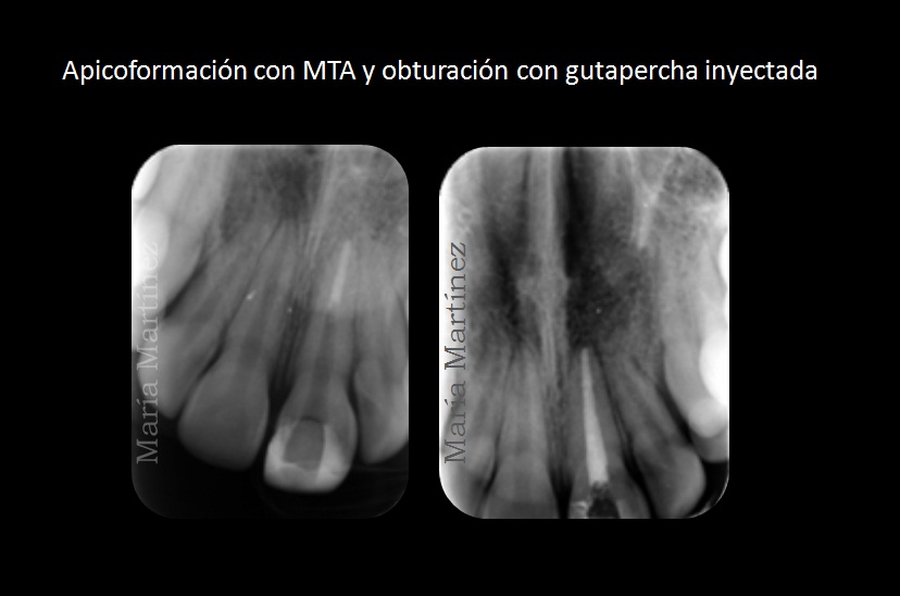 Máster en Odontología Restauradora y Endodoncia: Apicoformación con MTA ...