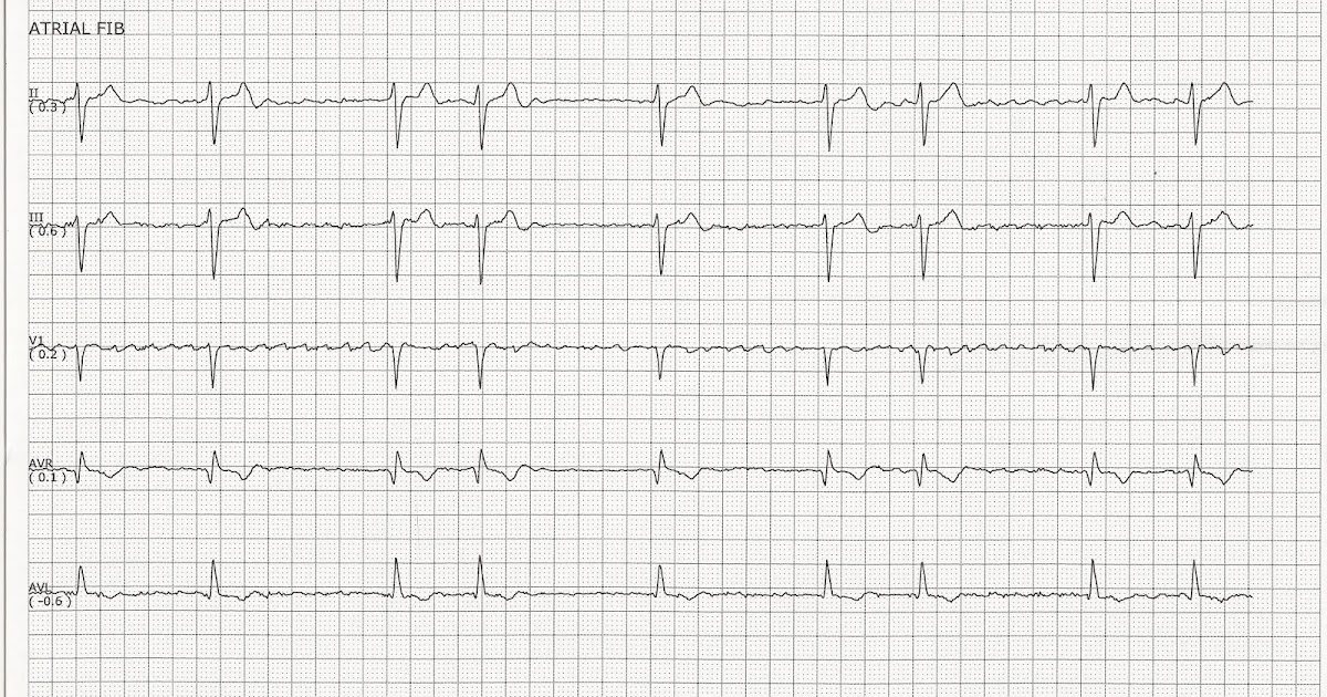 Float Nurse: Atrial fibrillation with slow ventricular response