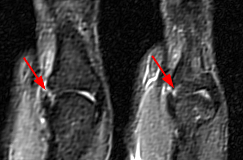 MRI Musculo-Skeletal Section: Ulnar collateral ligament.