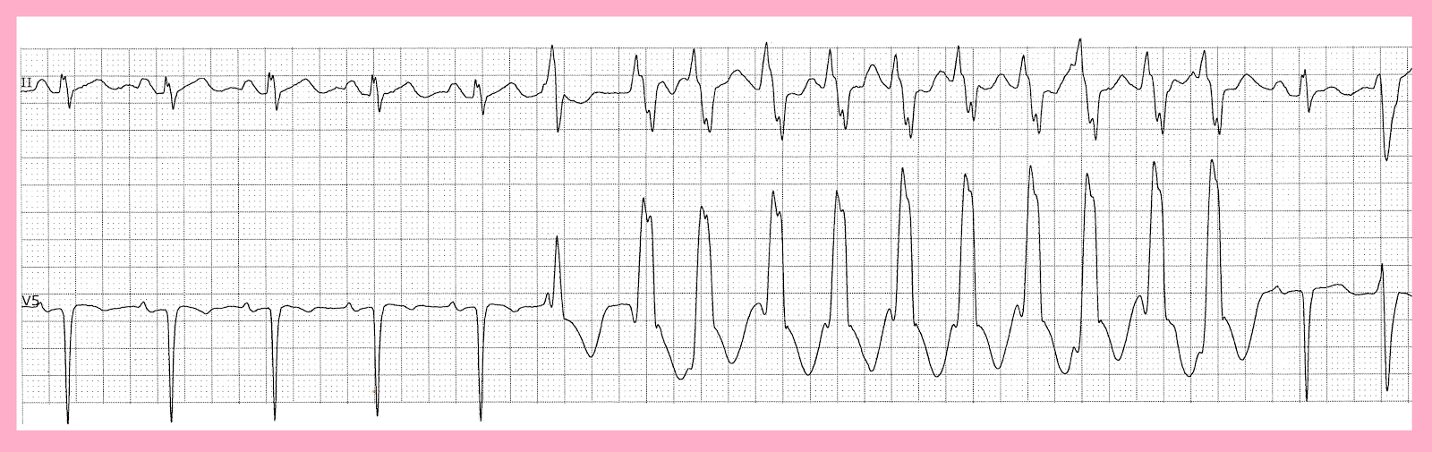 Float Nurse: Various Ventricular Tachycardias
