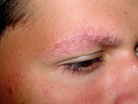 Scarlet Letters, dealing with vascular rosacea, face flushing, burning ...