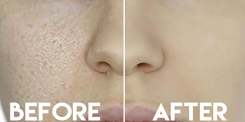 How To Close Open Pores Permanently At Home The Stylish Life