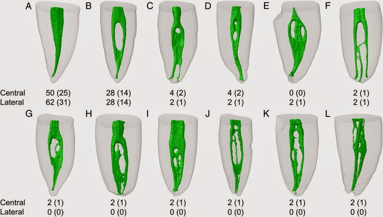 Anterior RCT teeth